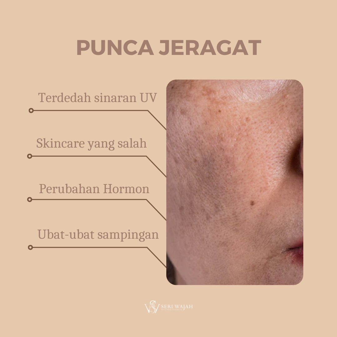 Jenis-jenis Jeragat - Seri Wajah